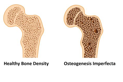 Osteogenesis Imperfecta News Dentagama