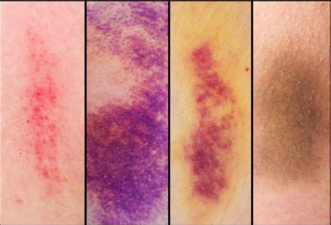 Pnile Bruising Prevention And Cure That Works For All Men Of All Ages