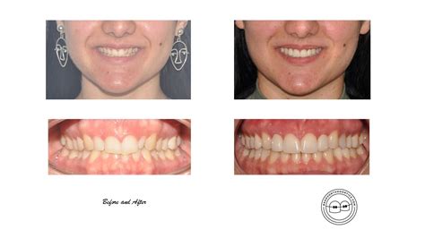 Incisor Classification Why Its Important Badov Orthodontics