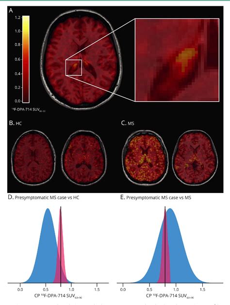 Figure 1 From Imaging Characteristics Of Choroid Plexuses In