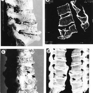 Pdf Molecular Analysis Of Skeletal Tuberculosis In An Ancient
