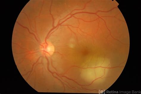 Tuberculoma Retina Image Bank