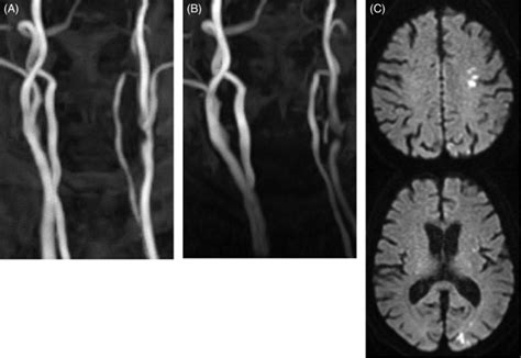 A Stenosis Of The Left Internal Carotid Artery Detected Incidentally