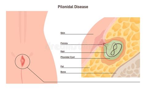 Pilonidal Sinus Stock Illustrations 6 Pilonidal Sinus Stock