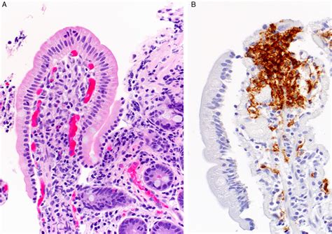 A A Very Subtle Single Aggregate Of Mast Cells In The Tip Of A Villus