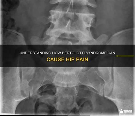 Understanding How Bertolotti Syndrome Can Cause Hip Pain Medshun