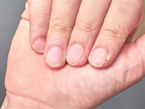 Onycholysis Psoriasis Onycholysis Nail Causes And Prevention