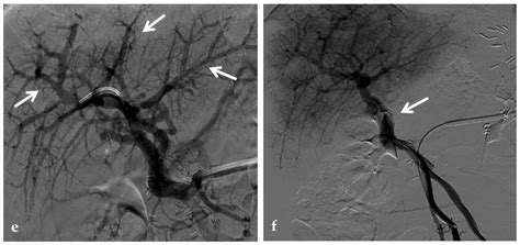 The Role Of Imaging In Portal Vein Thrombosis From The Diagnosis To