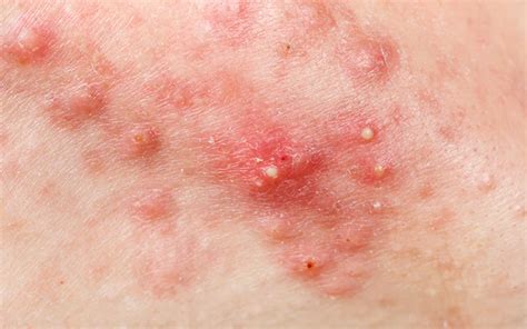 Skin Nodule Acne