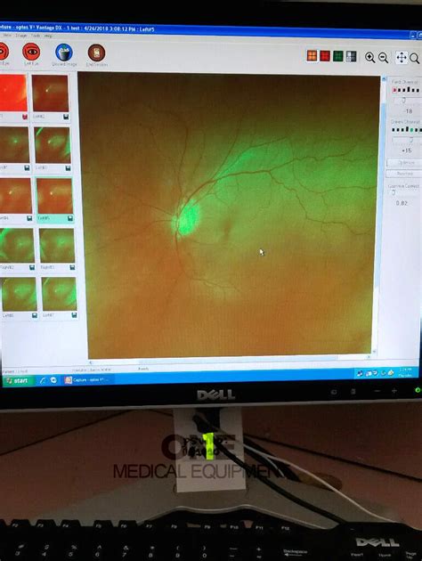 Optos Panoramic 200 Retinal Imaging