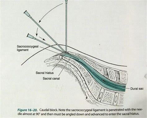 Caudal Block Anesthesia Anesthesiology Sketches