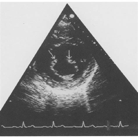 Pdf Cleft In The Anterior And Posterior Leaflet Of The Mitral Valve A Rare Anomaly