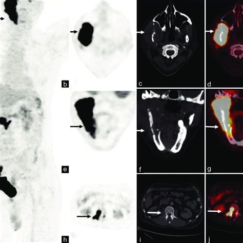 Mip A Image Of Postoperative Carcinoma Urinary Bladder Patient Download Scientific Diagram
