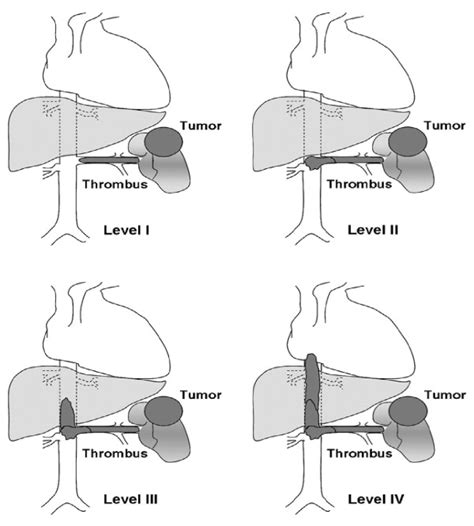 The Mayo Classification Of Macroscopic Venous Invasion In Renal Cell