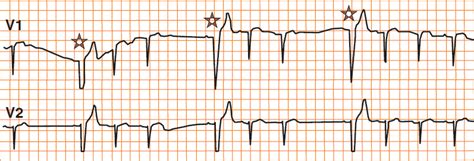 Phase 4 Block Bradycardia Dependent Block Ecg Book