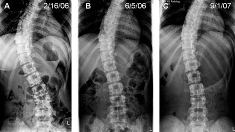 Thoracolumbar Scoliosis Exercises And Treatment Guide