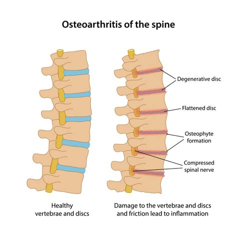 Osteophytes And Osteoarthritis Differentiation Of Osteophyte Types In