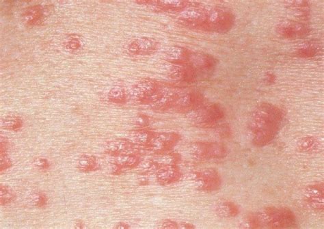 Микоза Микозите са кожни гъбични инфекции Aesthederm Eu