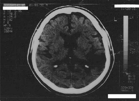 Ct Scan Showing Brbs Left Temporal Lesion After Cva Download