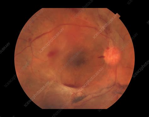 Proliferative Diabetic Retinopathy Stock Image C027 1513 Science Photo Library