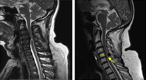 Mielopatía Cervical Espondilótica Neuro Recovery