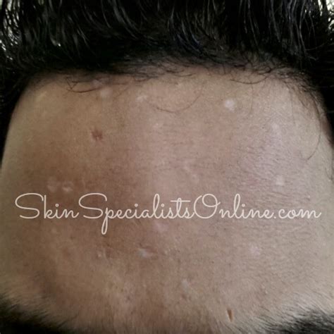 Ask A Skin Doctor Postinflammatory Hypopigmentation Skin Specialists