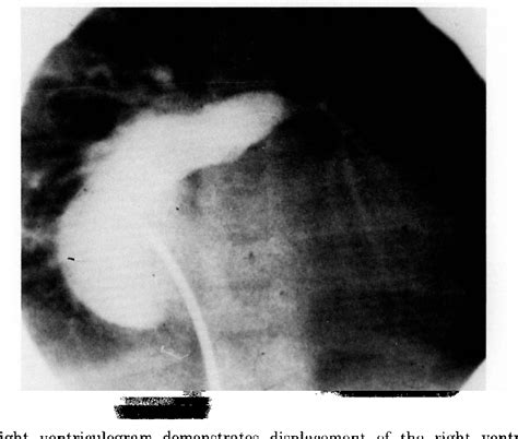 Figure 3 From Congenital Aneurysm Of The Left Atrium Semantic Scholar
