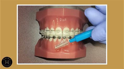 How To Use A Proxy Brush Invisalign And Braces For Teens And Adults Rockford Mi Youtube