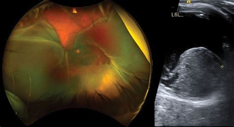 Surgical Management Of Retinal Detachment In Uveal Melanoma Retina Today