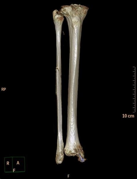 Weber Classification Of Ankle Fractures Radiology Reference Article