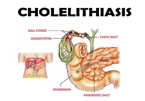 Cholelithiasis Medizzy