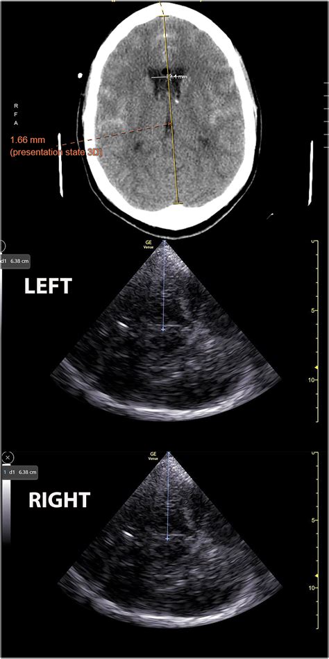 Transcranial Ultrasound In The Neurocritical Care Unit Neuroimaging