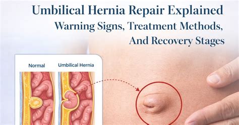 Understanding Umbilical Hernias What To Expect During Umbilical Hernia