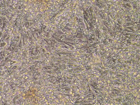 Revolutionary Stem Cell Therapy Offers New Hope For Heart Failure Patients