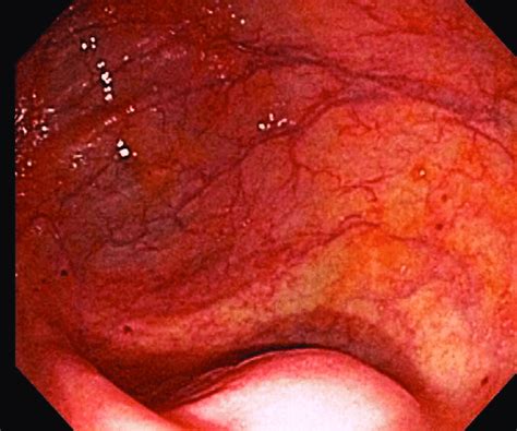 Protuberance At The Appendiceal Orifice Seen At Colonoscopy In Case 1 Download Scientific Diagram