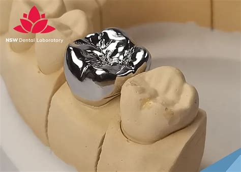 Metal Dental Crowns A Comprehensive Guide For Dentists And Patients