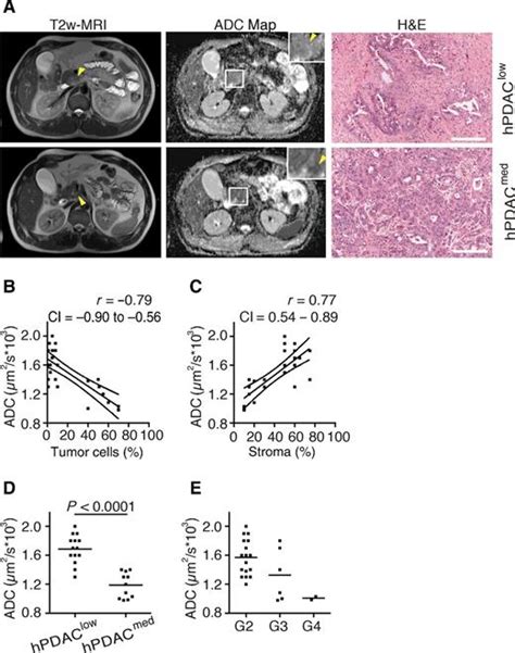 Co Clinical Assessment Of Tumor Cellularity In Pancreatic Cancer Clinical Cancer Research
