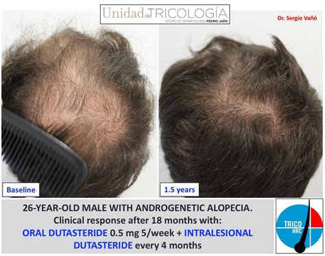 Dutasteride Dosage For Hair Loss 2024 Hairstyles Ideas