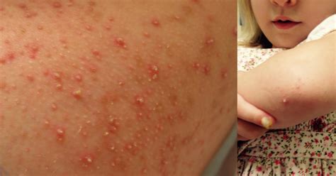 Follicular Hyperkeratosis