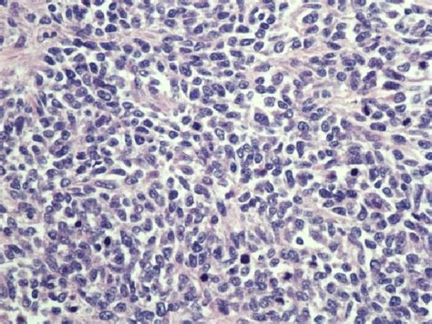 Low Power A And High Power B Views Showing Malignant Spindle Cells