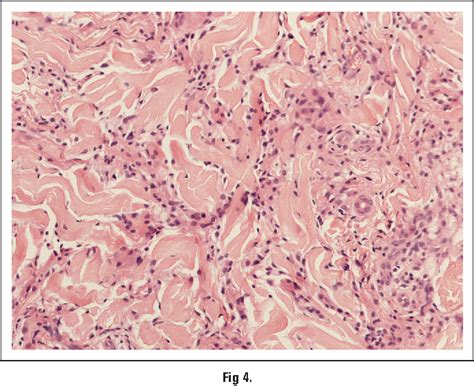 Scleromyxedema Histology