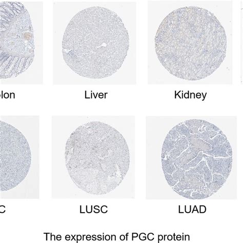 Expression Of Pgc Protein In Tumor Tissues Download Scientific Diagram