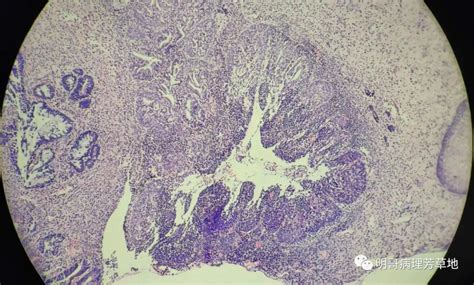 宫颈原位腺癌临床病理特征及病例分享