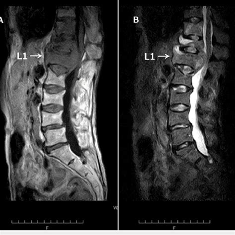 Chest X Ray On Admission Right Sided Mediastinal Shift And Tracheal