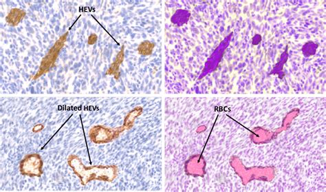Sentinel Lymph Node Ln High Endothelial Venule Hev Remodelling