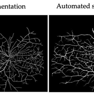 Comparison Of Manual And Automated Segmentation Of Retinal Vessels In A