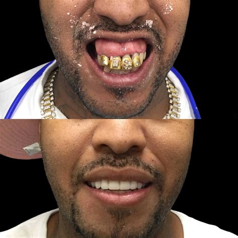 Dentures Before And After Richmond Hill Smile Centre We Customize