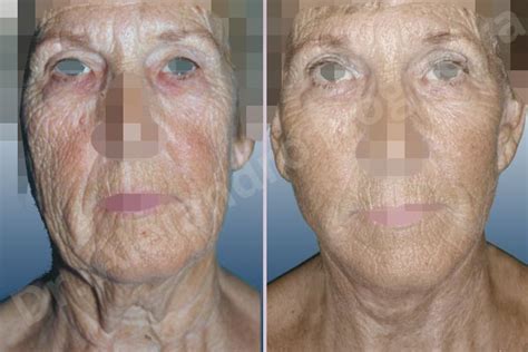 Face Lift And Neck Lift