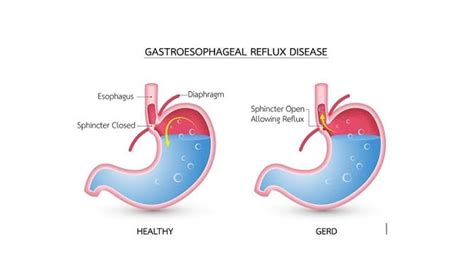 Gerd Gejala Penyebab Dan Pengobatan Alodokter