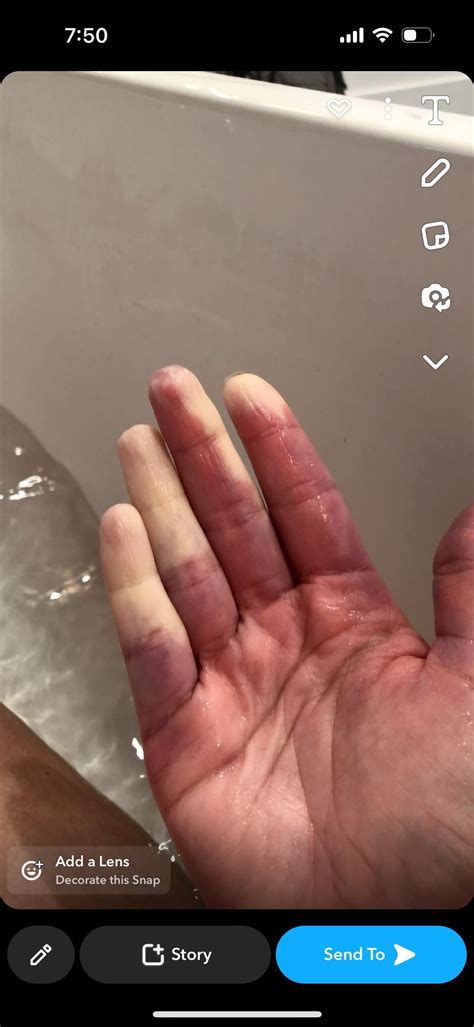 This Is What Limited Scleroderma Looks Like Rscleroderma